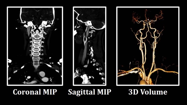 CTA Head and Neck | Video Lesson | Clover Learning