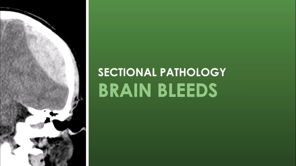 Ct Brain Bleeds Video Lesson Clover Learning