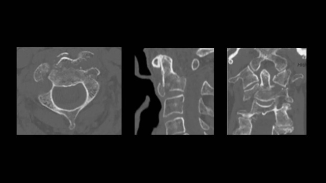 CT Spine General | Video Lesson | Clover Learning