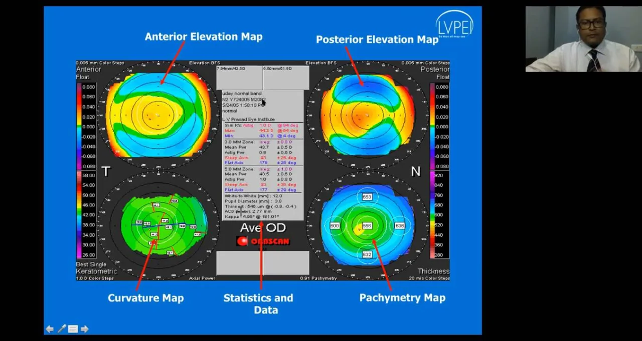 Normal Corneal Topography