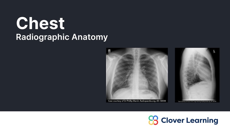 Chest: Radiographic Anatomy | Video Lesson | Clover Learning