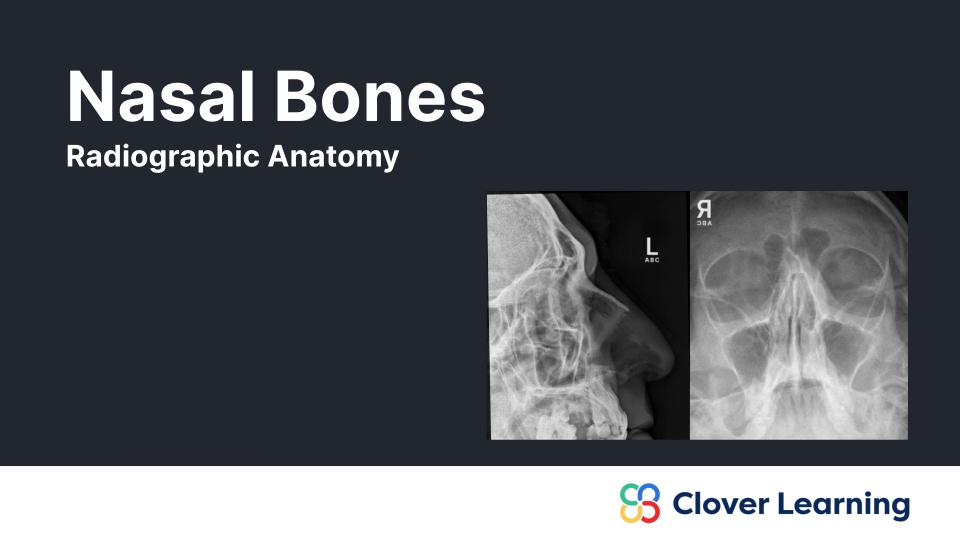 Nasal Bones: Radiographic Anatomy | Video Lesson | Clover Learning