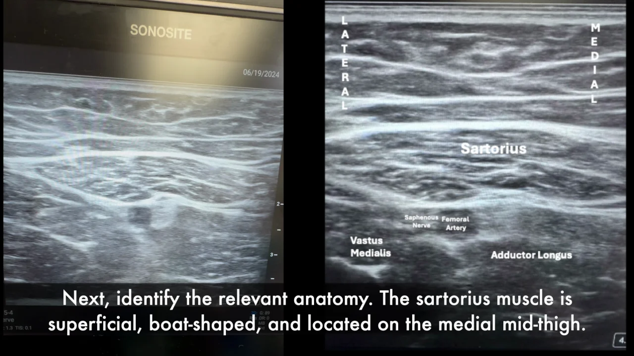Saphenous Nerve Block