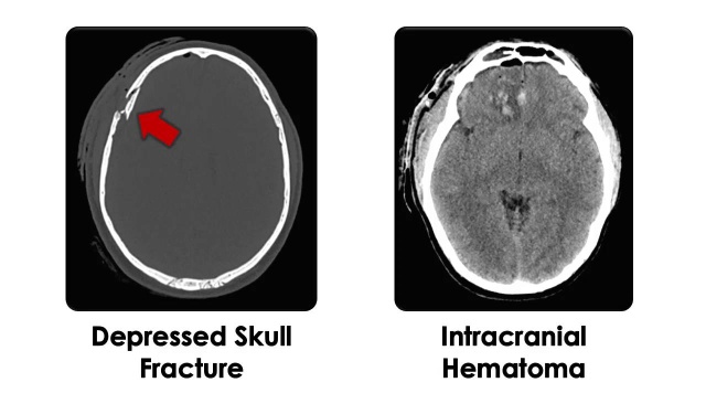 Skull Fractures | Video Lesson | Clover Learning