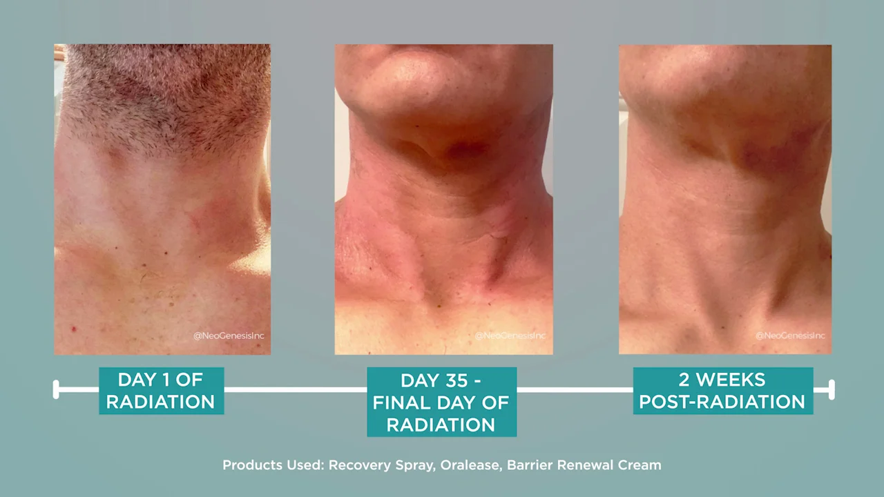 Radiation Side Effects