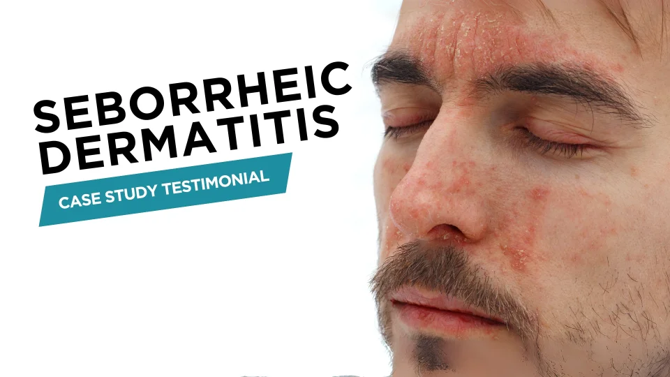 Managing Seborrheic Dermatitis with NeoGenesis Products