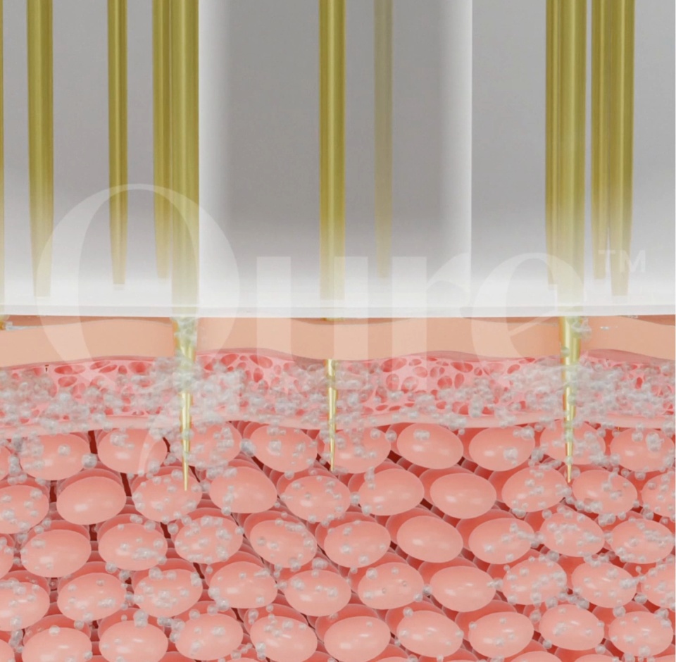 Micro-Infusion System – Qure Skincare