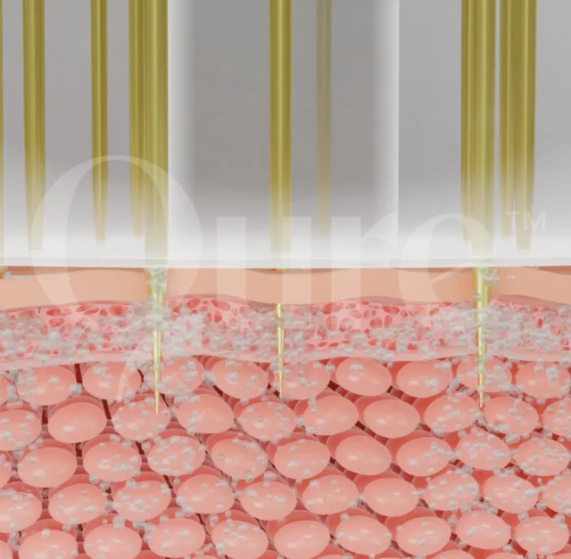 Micro-Infusion System – Qure Skincare