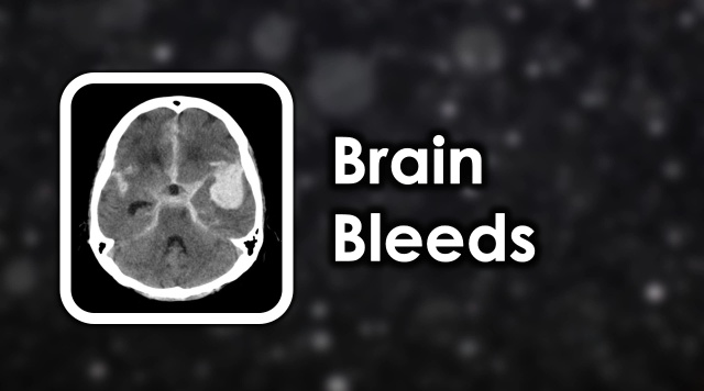 Brain Bleeds | Video Lesson | Clover Learning