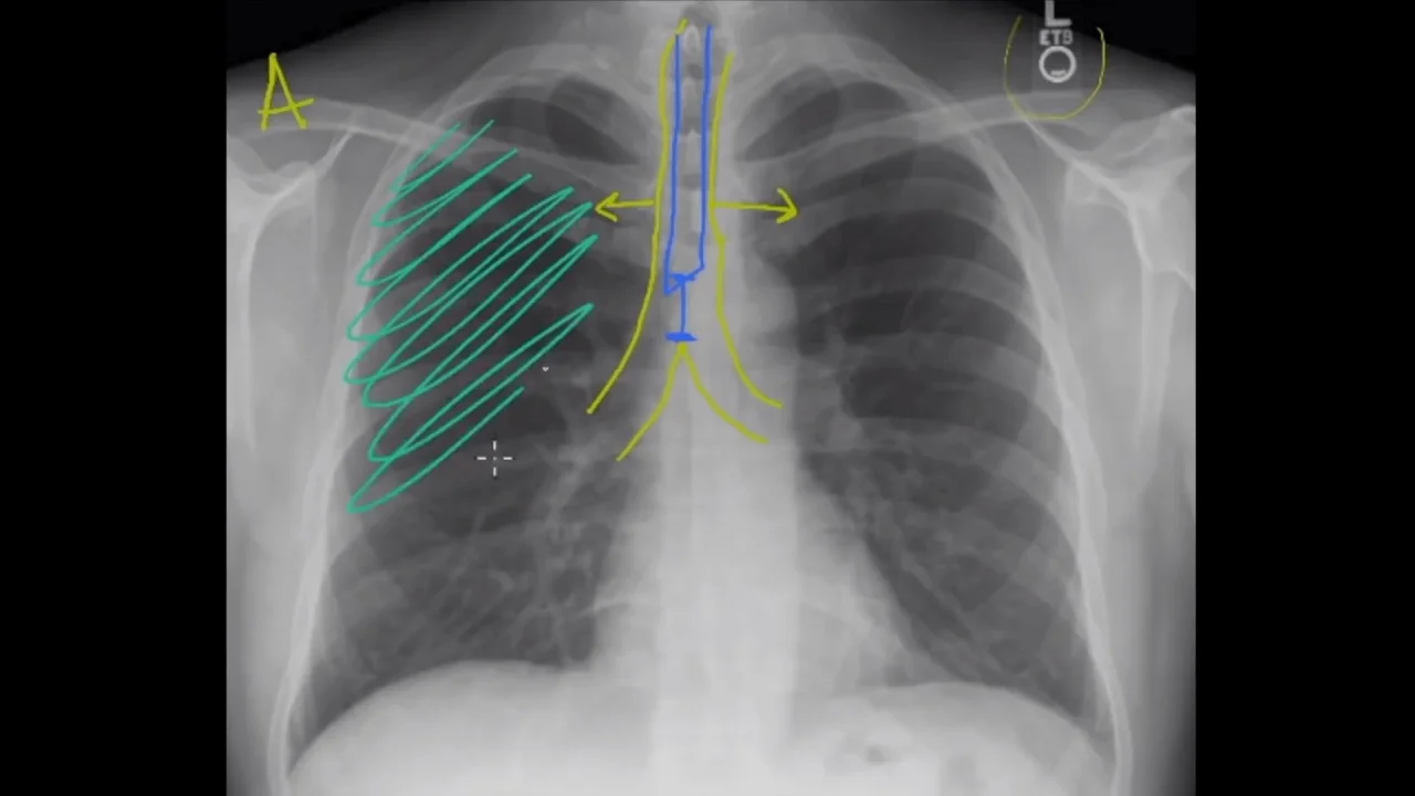 Chest X Ray Reading Abcde at Anthony Blubaugh blog Chest X Ray Reading Abcde at Anthony Blubaugh blog