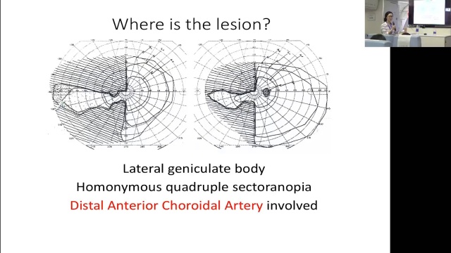 Lateral Geniculate Visual Field