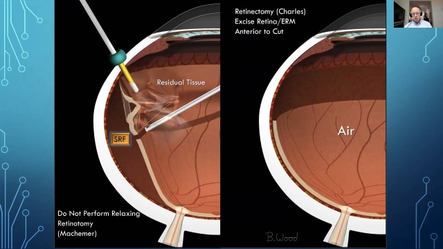 Vitrectomy Retinal Detachment