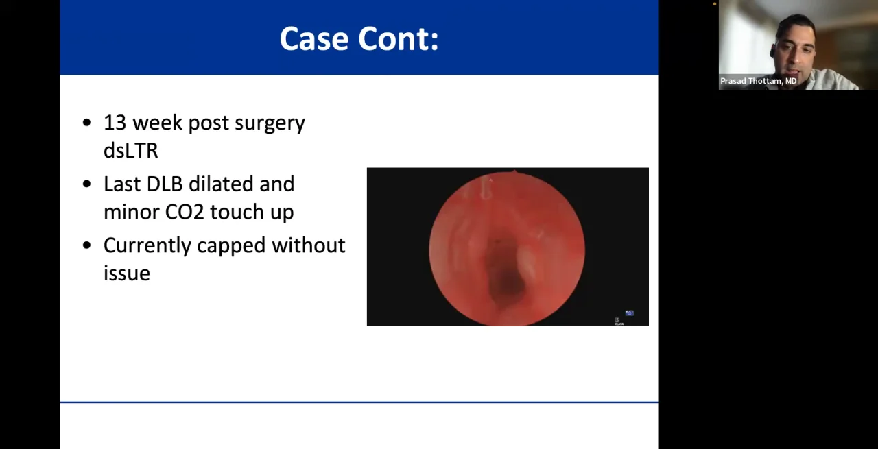 Webinar: IPAS 2022: Open Airway Subglottic: LTR & CTR | CSurgeries
