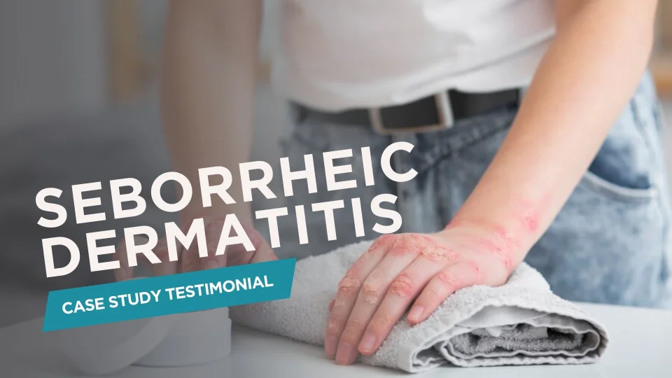 Managing Seborrheic Dermatitis with NeoGenesis Products