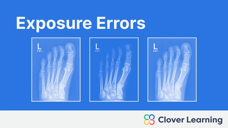 Exposure Errors | Video Lesson | Clover Learning
