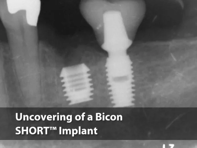 Uncovering of a Bicon SHORT® Implant - Bicon Dental Implants