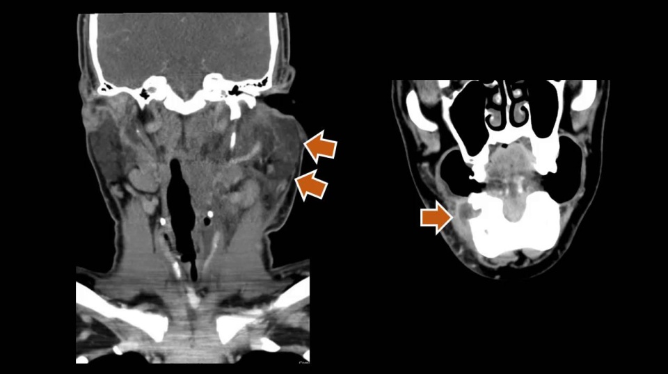CT Facial Bones | Video Lesson | Clover Learning
