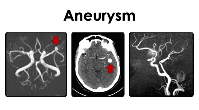 Brain Aneurysms | Video Lesson | Clover Learning