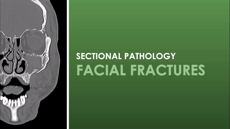 CT Facial Fractures | Video Lesson | Clover Learning