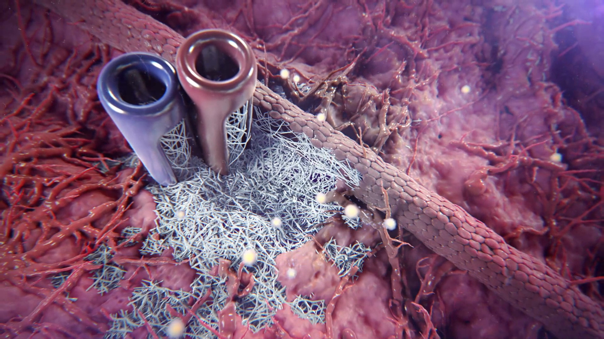 Nanoknife for Prostate Cancer Arizona - East Valley Urology Center of ...