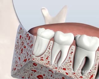 Wisdom Teeth Removal Video | Victor Oral Surgery & Dental Implants