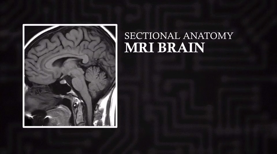MRI Brain (Sagittal) | Video Lesson | Clover Learning
