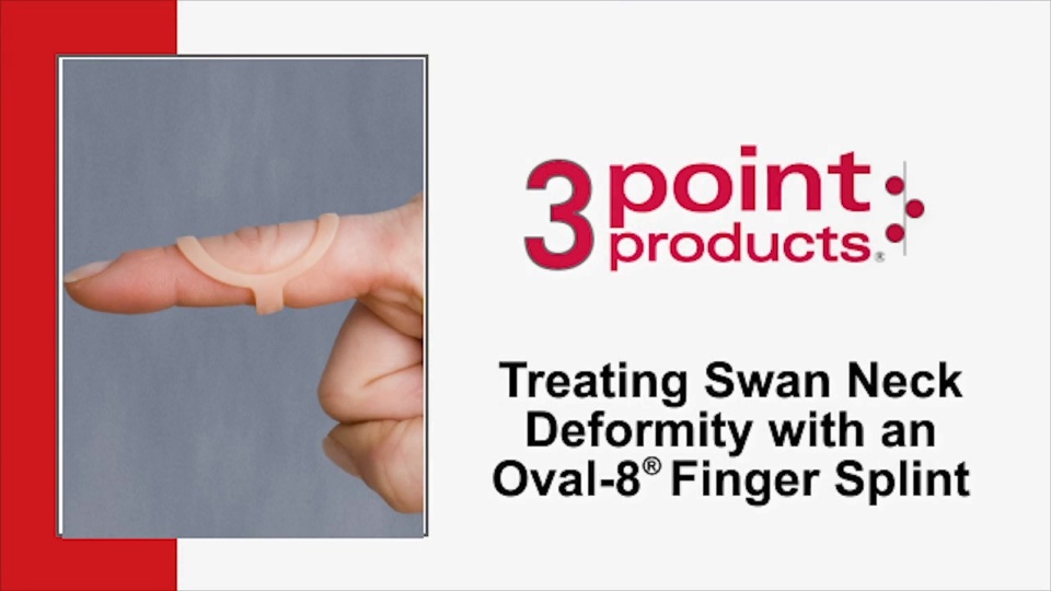 How to Treat Swan Neck Deformity with an Oval-8 | 3-Point Products Video