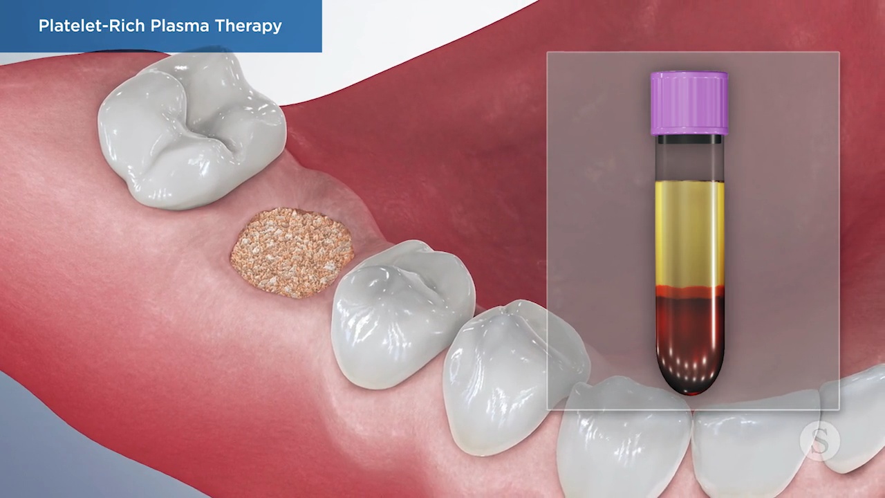 Platelet-rich plasma (PRP) therapy - Premier Dental Associates