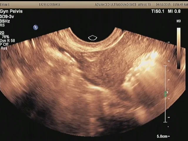 Sono HSG Procedure Using ABBI: Fallopian Tube Patency - CooperSurgical