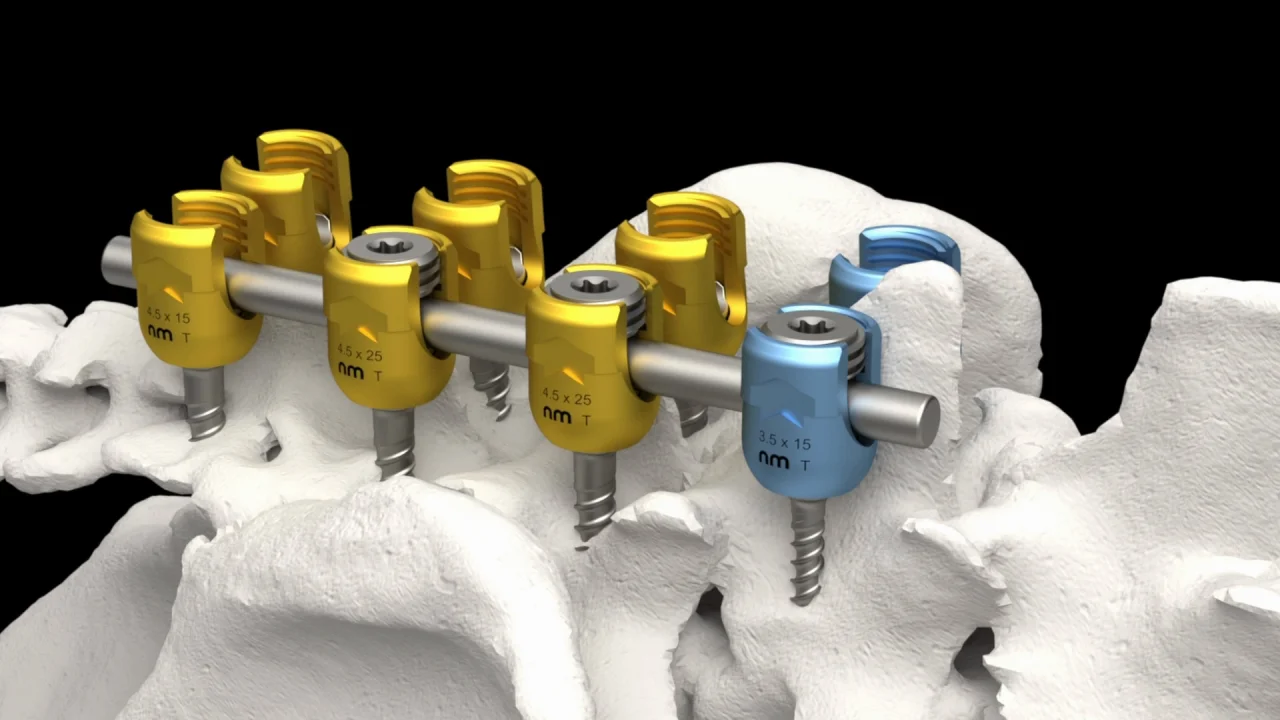 Pedicle Screw Fixation Surgery