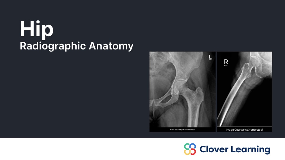 Hip: Radiographic Anatomy | Video Lesson | Clover Learning