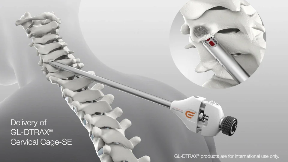 Posterior Cervical Fusion with DTRAX Spinal System | Providence