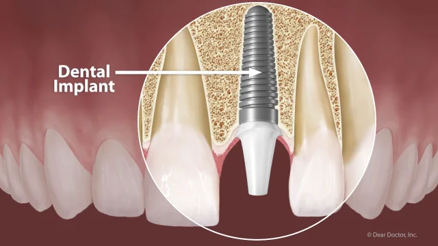 Dental Implants in Palm Beach Gardens & Jupiter FL | Implant Teeth