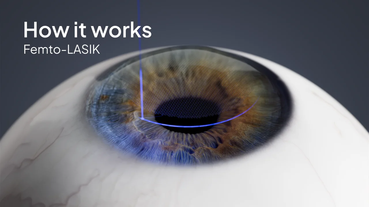 Femto lasik store
