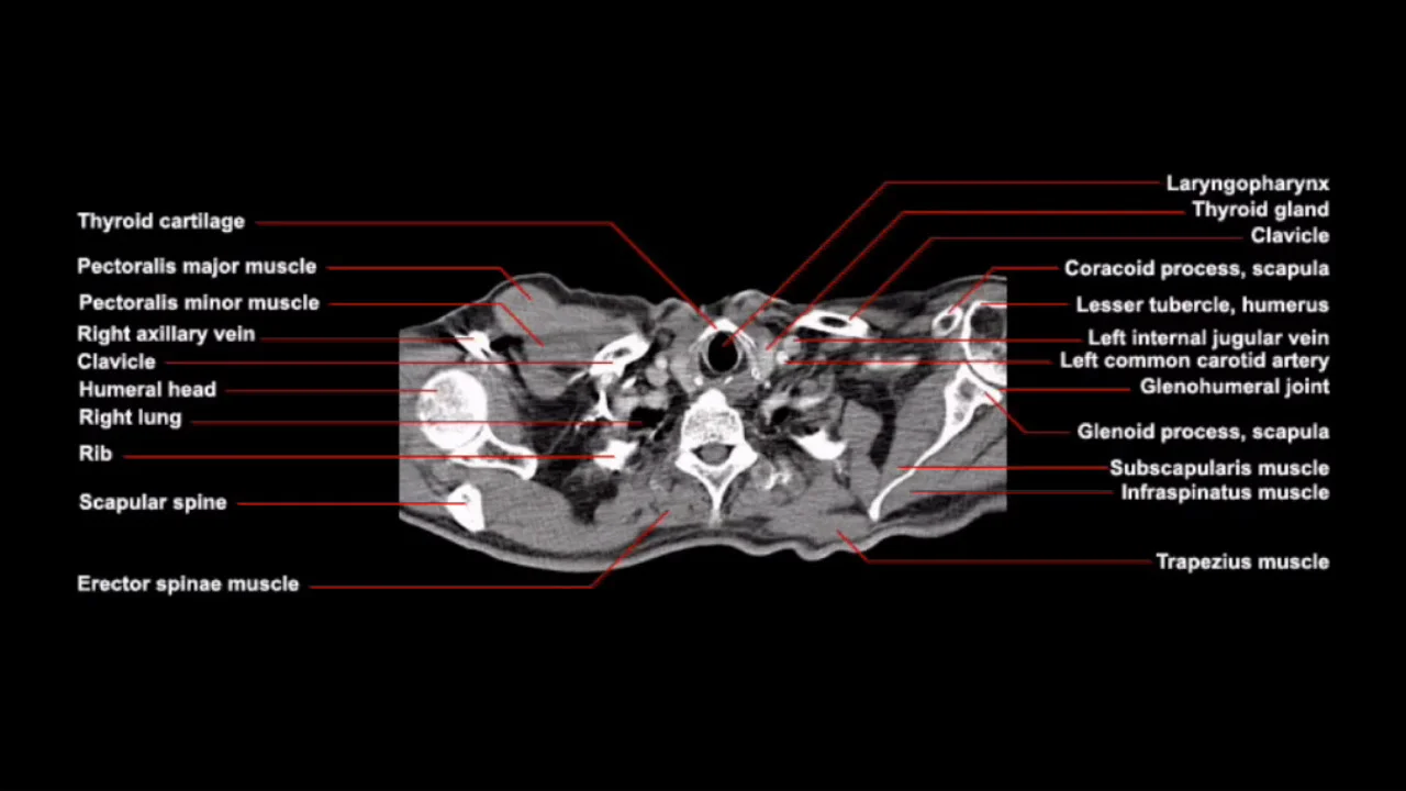 Ct Anatomy Chest