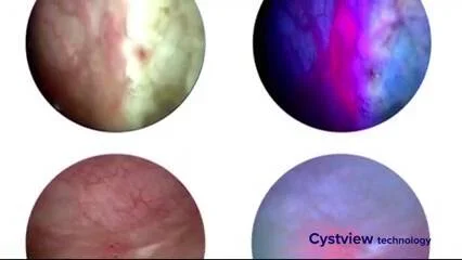 Blue Light Cystoscopy Locations | Shelly Lighting