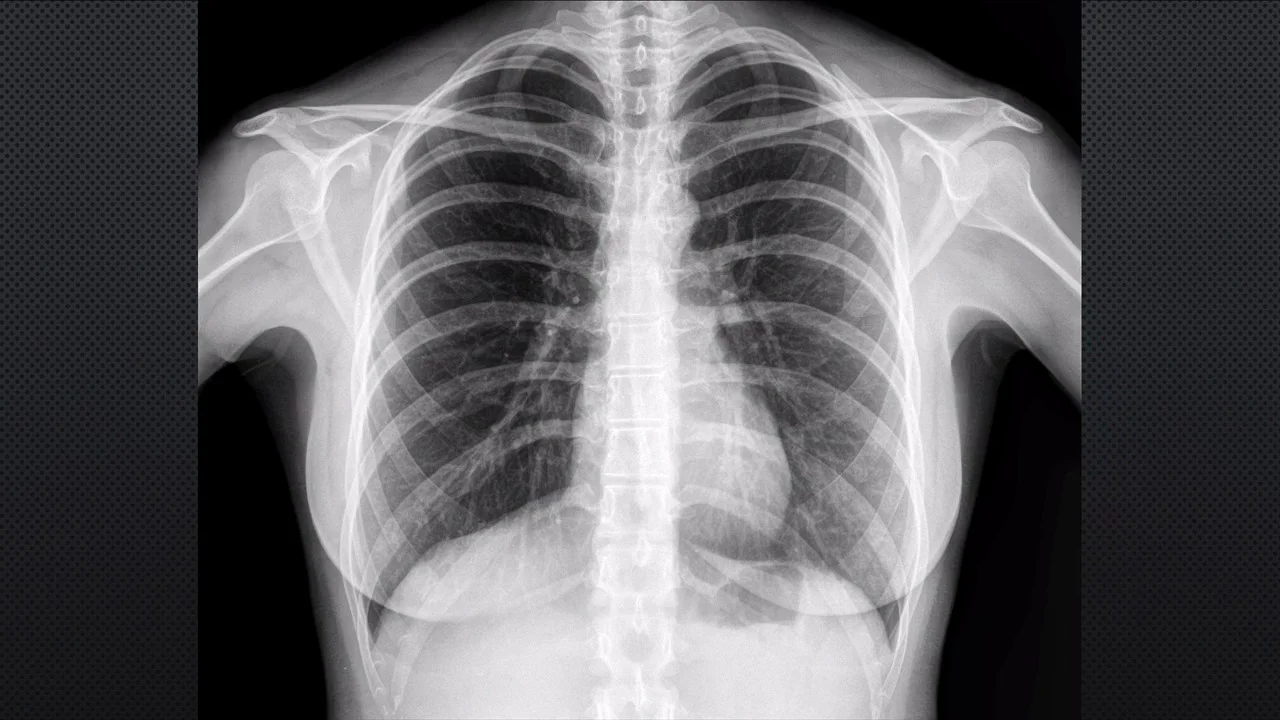 X Ray Chest Anatomy