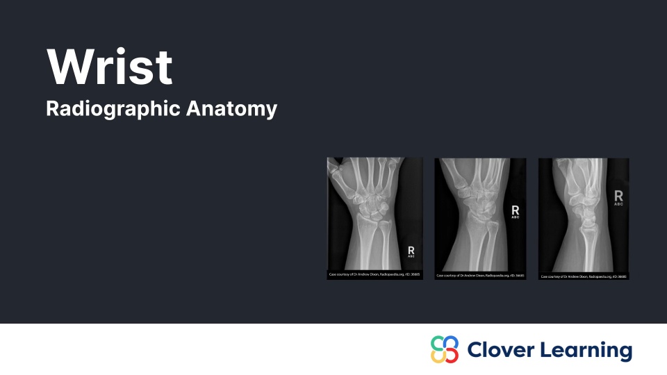 Wrist: Radiographic Anatomy | Video Lesson | Clover Learning