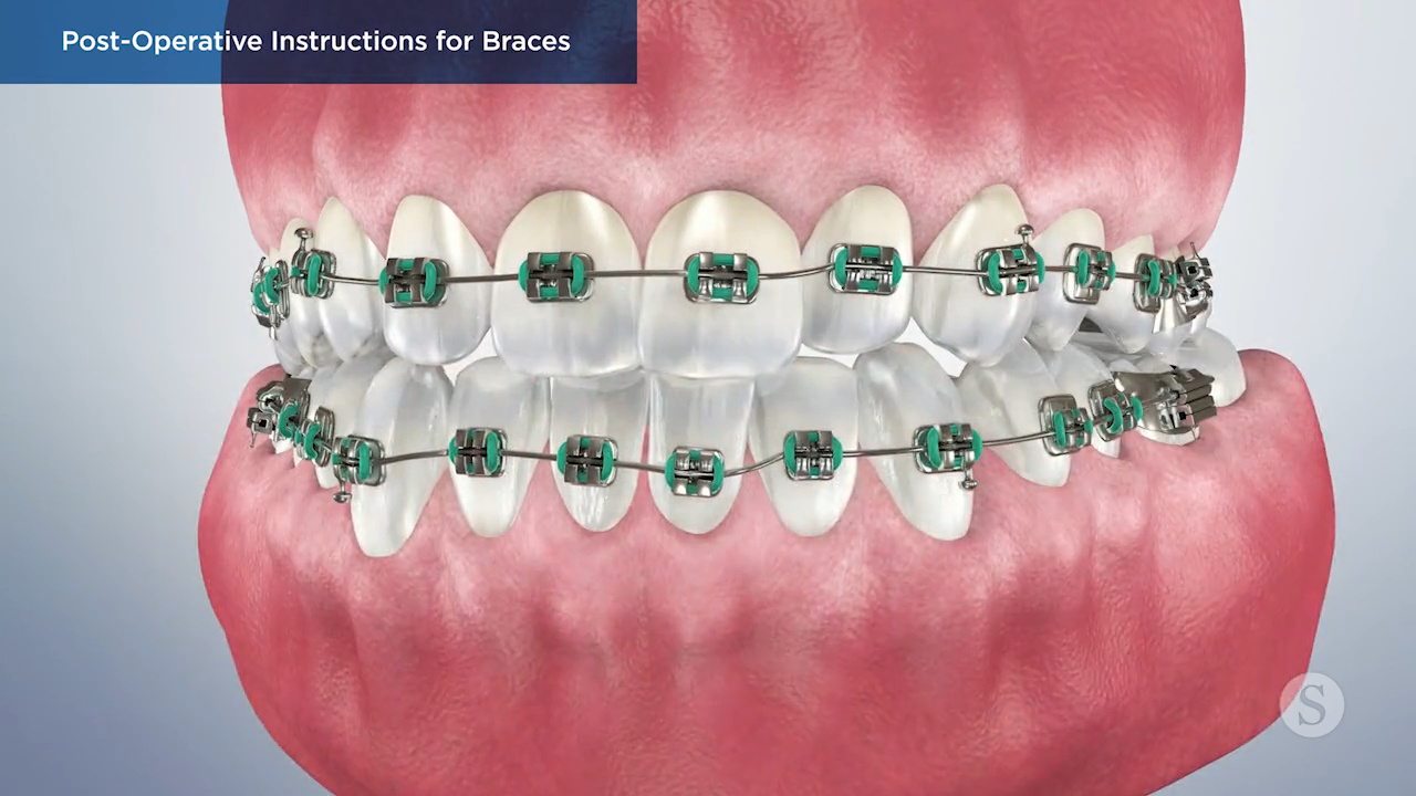 Guide to Braces - Cooper Orthodontics Houston Texas